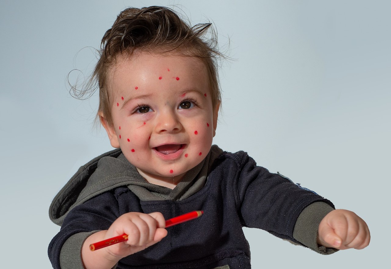 Varičele (ovčije boginje) - najčešća bolest dečijeg uzrasta