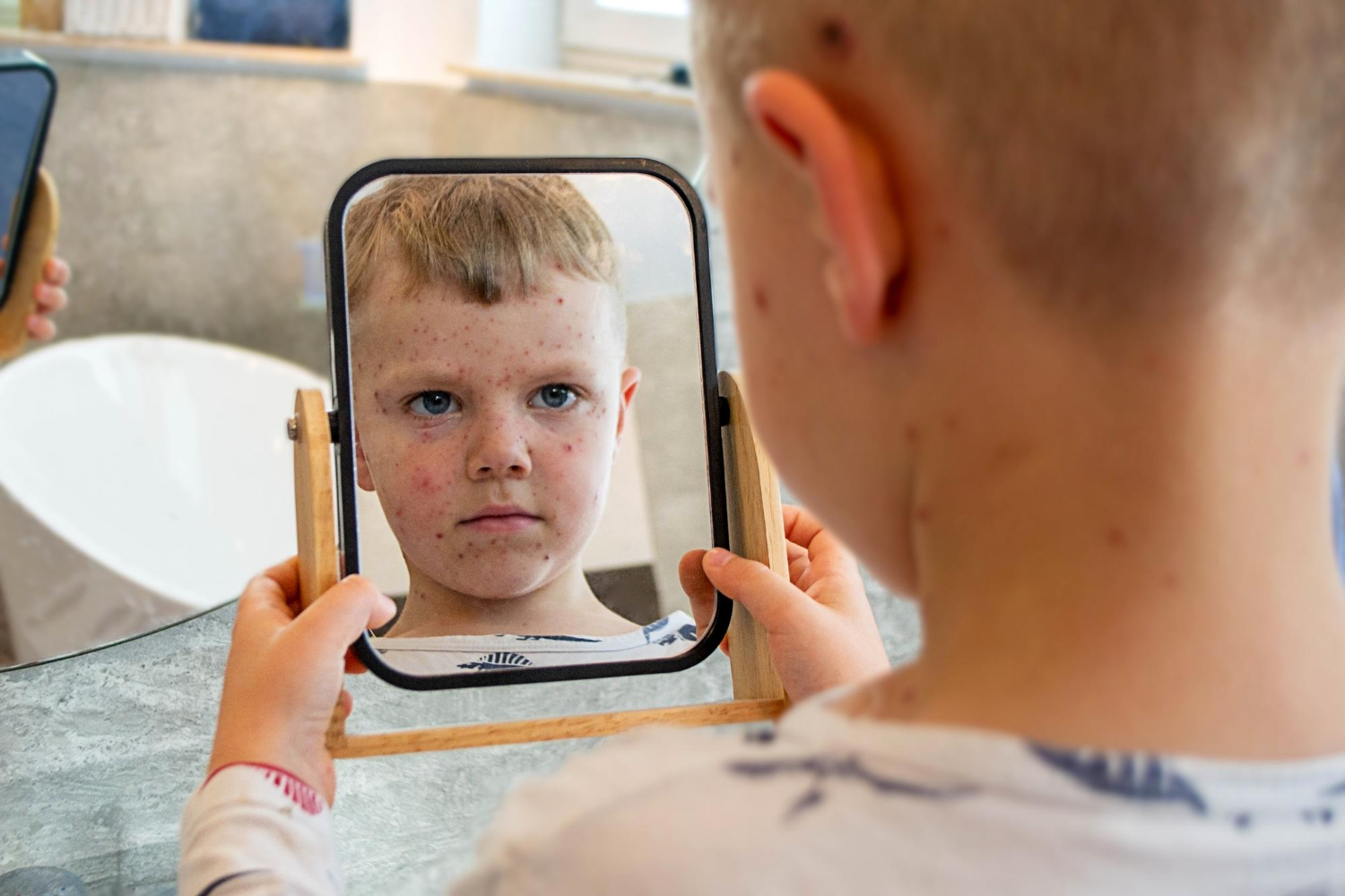 Blizu 5.000 zaraženih od malih boginja, proglašena epidemija u BiH